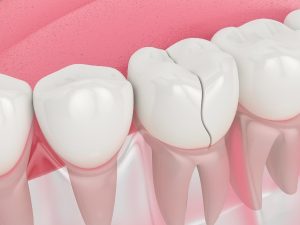 Diente fracturado, cómo restaurarlo | Clínica Dental Portaceli